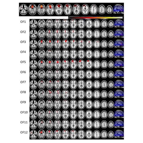 Lesion Characteristics Of The Orbitofrontal Cortex Lesion Group