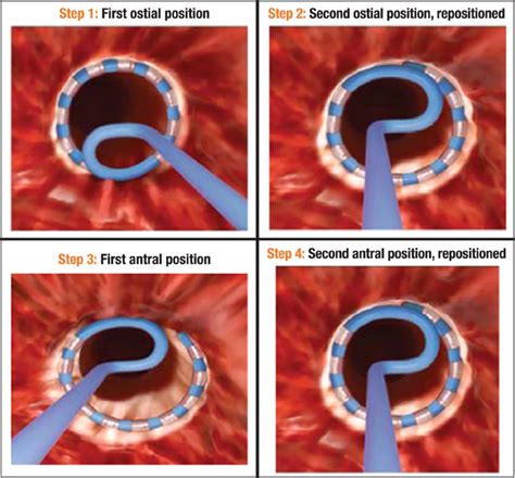 The Varipulse Pulsed Field Ablation Platform Cardiac