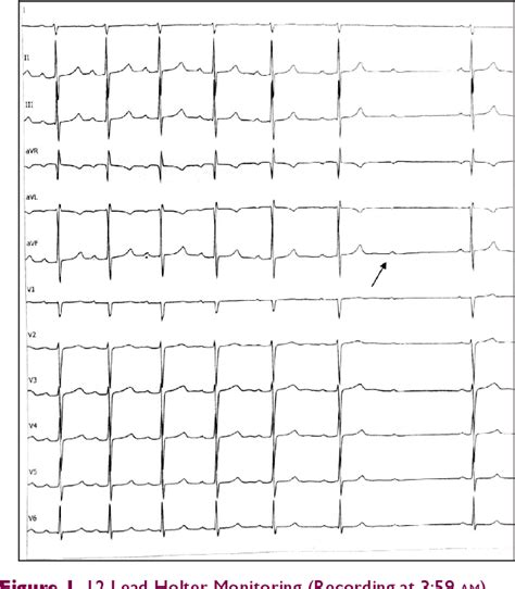 Figure 1 From Vagally Mediated Av Block Semantic Scholar