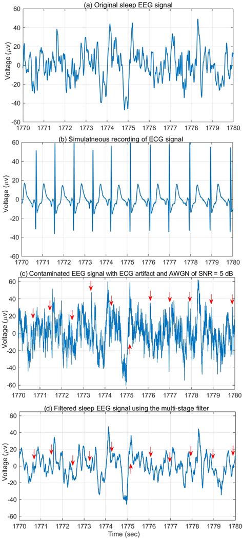 a clean sleep eeg signal b ecg interference c noisy eeg signal