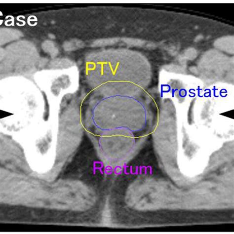 Axial Ct Image Of The Prostate Cancer Case The Yellow Blue And Download Scientific Diagram