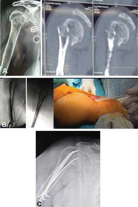 Case Preoperative Imaging Of Patient With Two Part Proximal Download Scientific Diagram