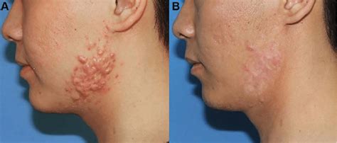 A Patient With Multiple Lesions Of Keloids On His Face Prior To Download Scientific Diagram