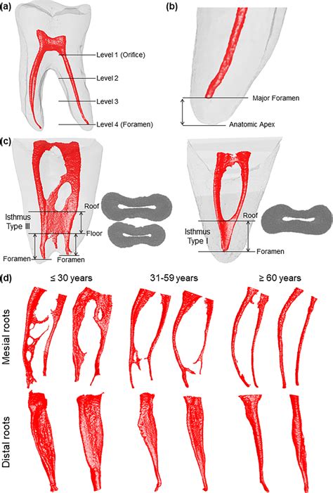 Root Canal Anatomy Which Root Canal Treatment Is Easier Incisor Or