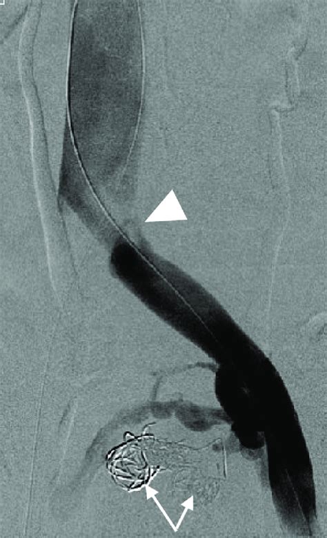 Venogram After Coil Embolization Of Iliac Vein Aneurysms Arrows