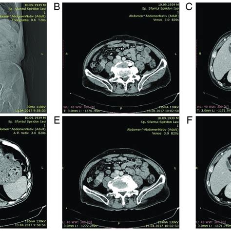 A F Abdominal Ct Scan Showing A Mass On The Terminal Ileum Of The Download Scientific Diagram