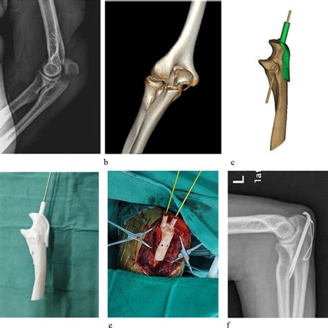 A 33 Year Old Man Treated With Free Hand Tbw For Olecranon Fracture Download Scientific