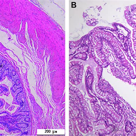 Pathological Results A The Duplicated Intestinal Canal Exhibited The