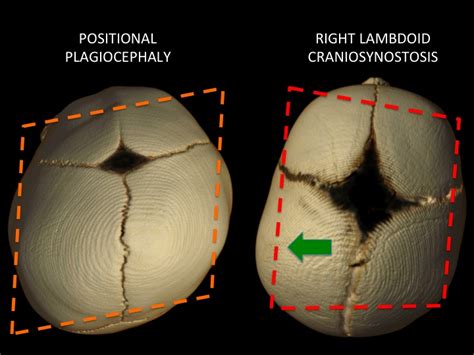 Positional Plagiocephaly — Dallas Pediatric Plastic Surgeon Craniofacial Surgeon Cleft Lip And