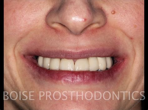 Boise Idaho Prosthodontics Ectodermal Dysplasia Maxillary Rehab Implants And Teeth And