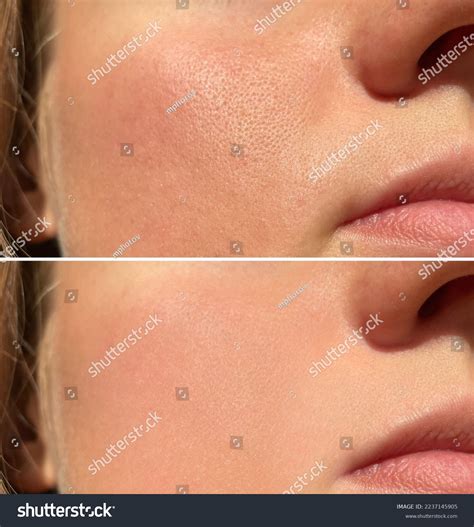 Woman Face Skin Pores Before After Stock Photo 2237145905 Shutterstock