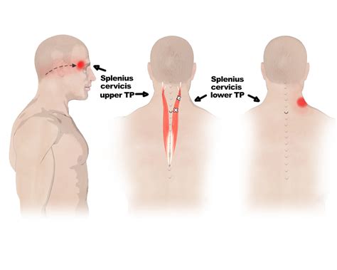 Splenius Muscles Their Attachments And Actions Yoganatomy