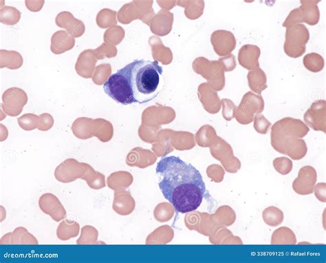 Hemophagocytosis By Plasma Cells In A Case Of Multiple Myeloma Stock