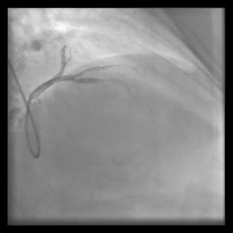 Angiographic Dataset For Stenosis Detection Object Detection Model By