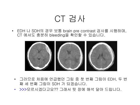 PPT EDH Vs SDH PowerPoint Presentation Free Download ID 6701929