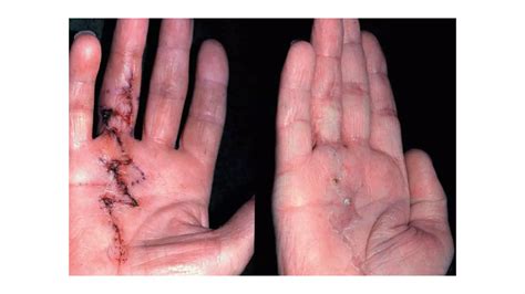 Photo Session Dupuytrens Contracture Pptx