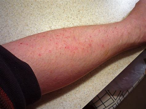 Adult Skin Rash Common Causes And Natural Treatments
