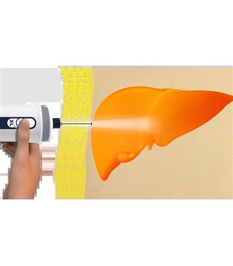 Fibroscan® With Cap™ For Fatty Liver Disease Assessment Echosens