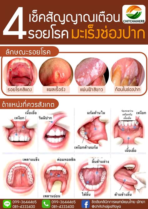 📣 มะเร็งช่องปาก ชิตชัยคลินิกการแพทย์แผนไทย พัทยา
