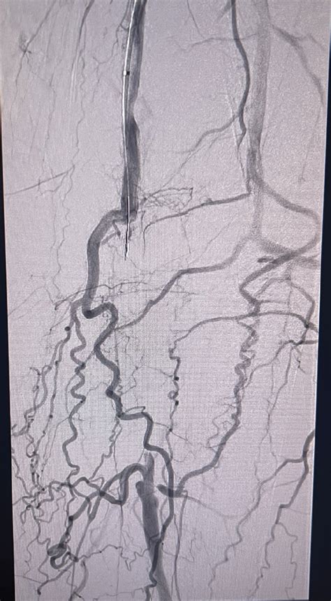 Use Of Serranator As Standalone Treatment In A Sfa Occlusion Endovascular Today