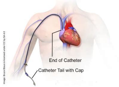 Intravenous Therapy Through A PICC Line At Home Kingston And Richmond NHS Foundation Trust