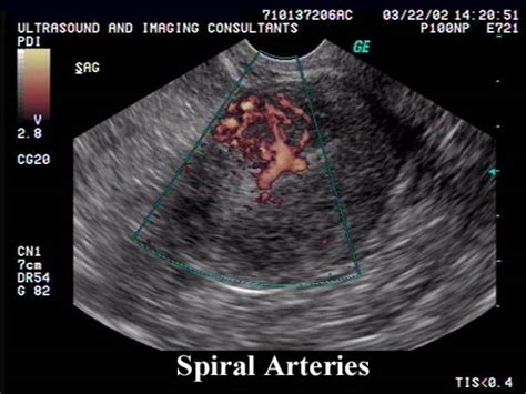 The Uterus Prior To The Visualization Of The Gestational Sac