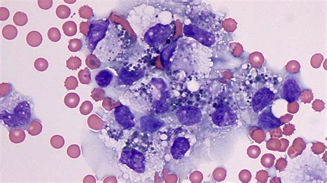 Hemosiderophage Archives Eclinpath
