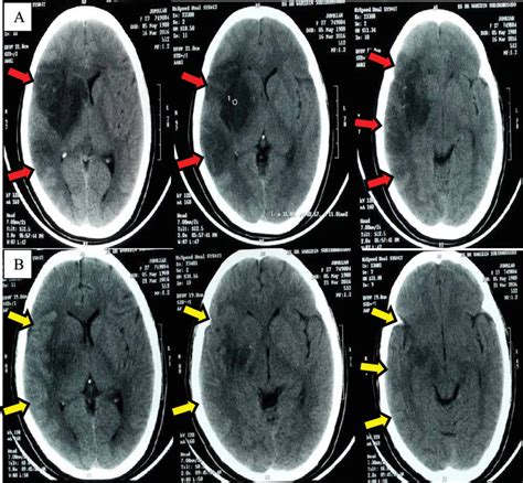 Gambar 1 Ct Scan Kepala A Awal Memperlihatkan Infark Serebral Masif Download Scientific