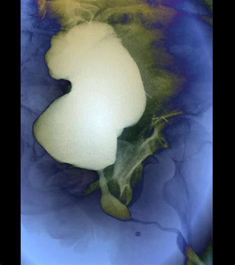 Augmented Bladder Photograph By Zephyr Science Photo Library