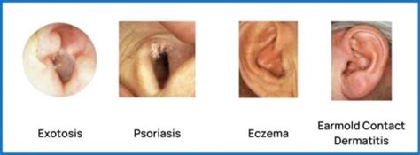 Common Conditions Of The External Ear Pacific Audiology Group