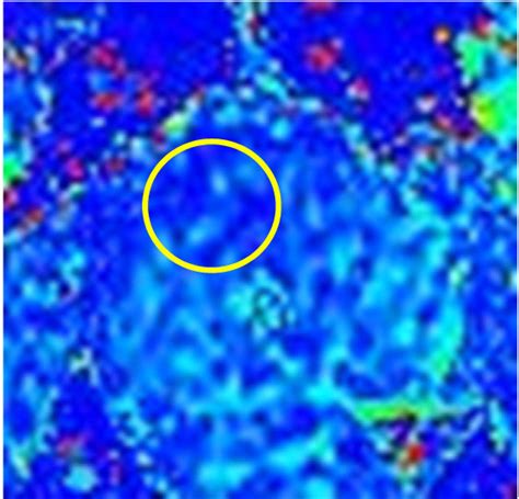 Adc Maps Of The 19th Sample Fitted With Dwi Color Scales Are Given In