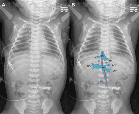 Umbilical Artery Catheter