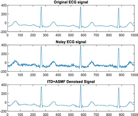 figure 5 from ecg denoising methodology using intrinsic time scale