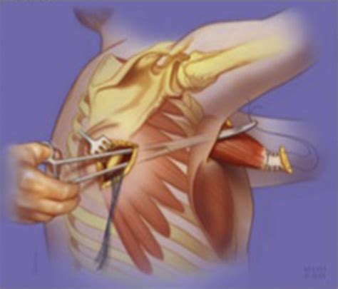 Anatomy Etiology And Management Of Scapular Winging Journal Of Hand
