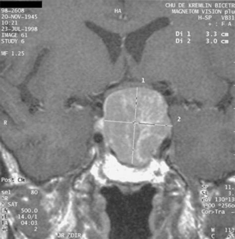 Pituitary Adenoma Acromegaly Endocrine Medbullets Step 23