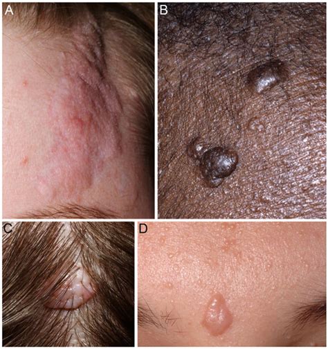 Fibrous Cephalic Plaques In Tuberous Sclerosis Complex Pmc