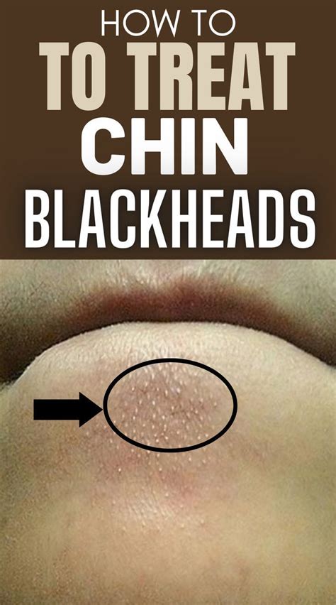 How To Quickly And Easily Remove Blackheads From Your Chin At Home