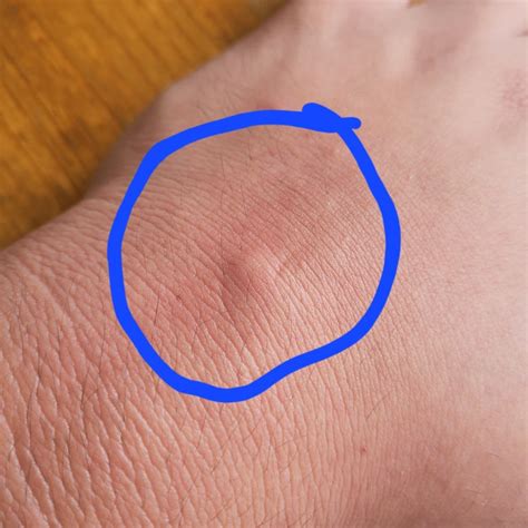 모기 벌레물린자국 지식in