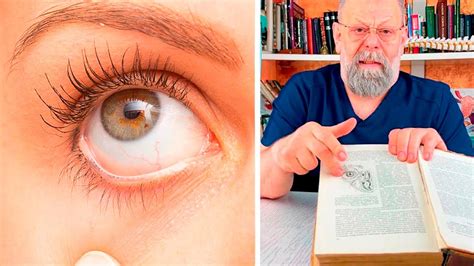 Жировики на веках Почему возникают и как избавиться Youtube