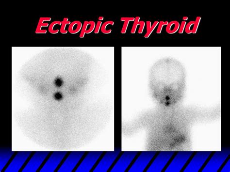 Ppt Thyroid Scan Powerpoint Presentation Free Download Id437897