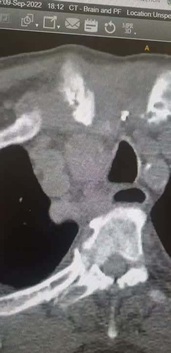 Nader Abdelrahman Abu Ghosh Md On Linkedin 1r Eus Fnb Cook