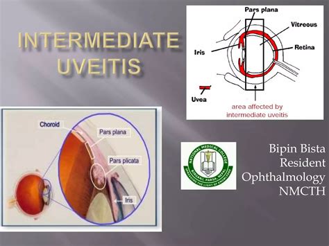 Intermediate Uveitis Pptx Eye And Vision Conditions Diseases And