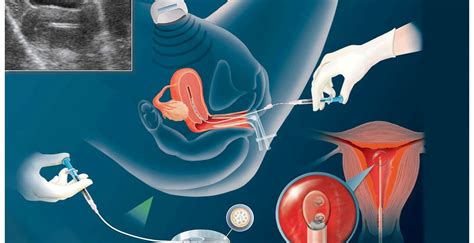 29 Facts About Hypophysectomy