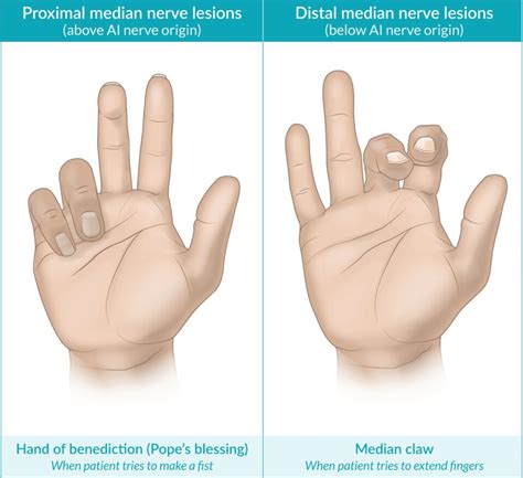 Why Does The Location Of Median Nerve Injury Lead To Different Patterns