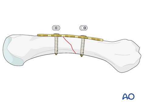 Compression Plating With Without Lag Screw For Simple Oblique Fracture Of The Diaphysis