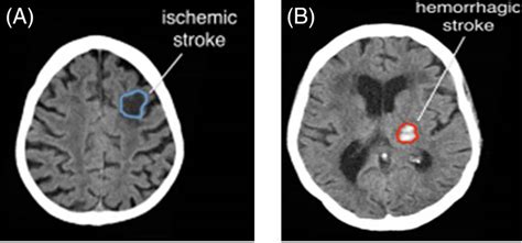Illustration Of A Ischemic Stroke Detection And B Hemorrhagic