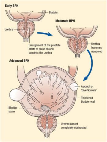 Urology Information Benign Enlargement John Donohue