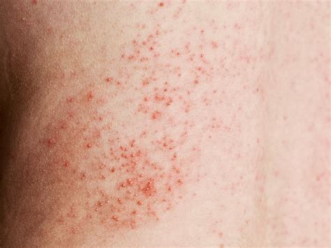 10 Signs The Skin Around Your Stoma Is Not Okay Sm Health Care