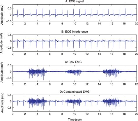 Figure 1 From A Novel Approach For Removing Ecg Interferences From Surface Emg Signals Using A