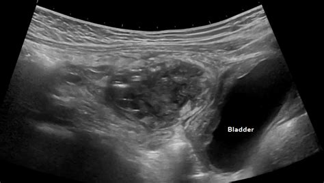 Appendix Ultrasound Sonographic Tendencies